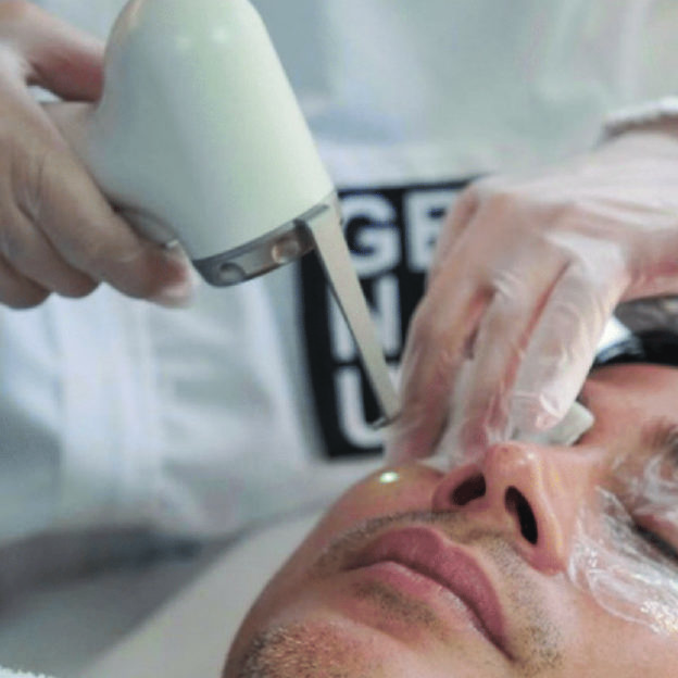 Infrared Laser Treatment for Acne Scars - French Radiance Esthetics